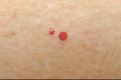 Cherry Angioma | SkinIO