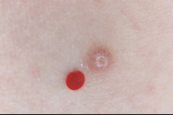 Dermatofibroma | SkinIO