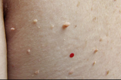 Skin Tags | SkinIO