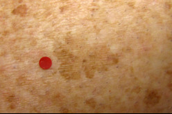 Solar Lentigo | SkinIO